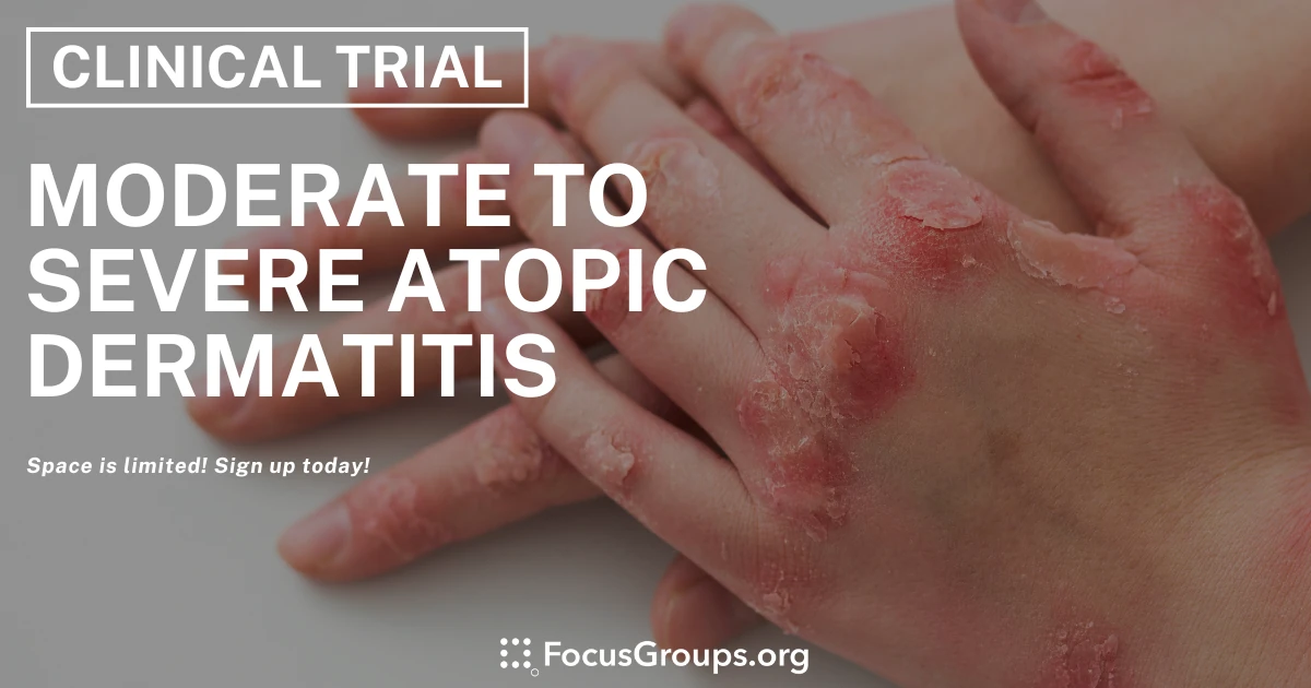 Clinical Trial on Moderate to Severe Atopic Dermatitis - FocusGroups.org